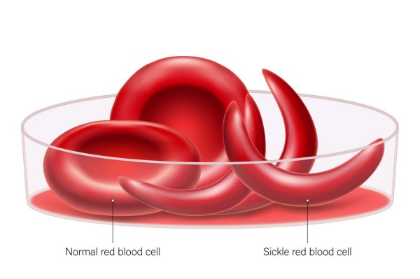 How Netflix’s Supacell boosts sickle cell disease awareness | Blue Cross NC